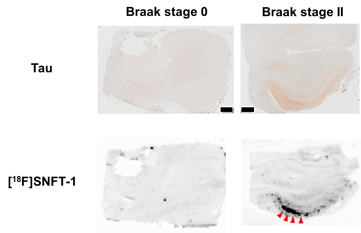 A Novel PET Tracer 18F-SNFT-1 for Early Detection of Tau Pathology in ...
